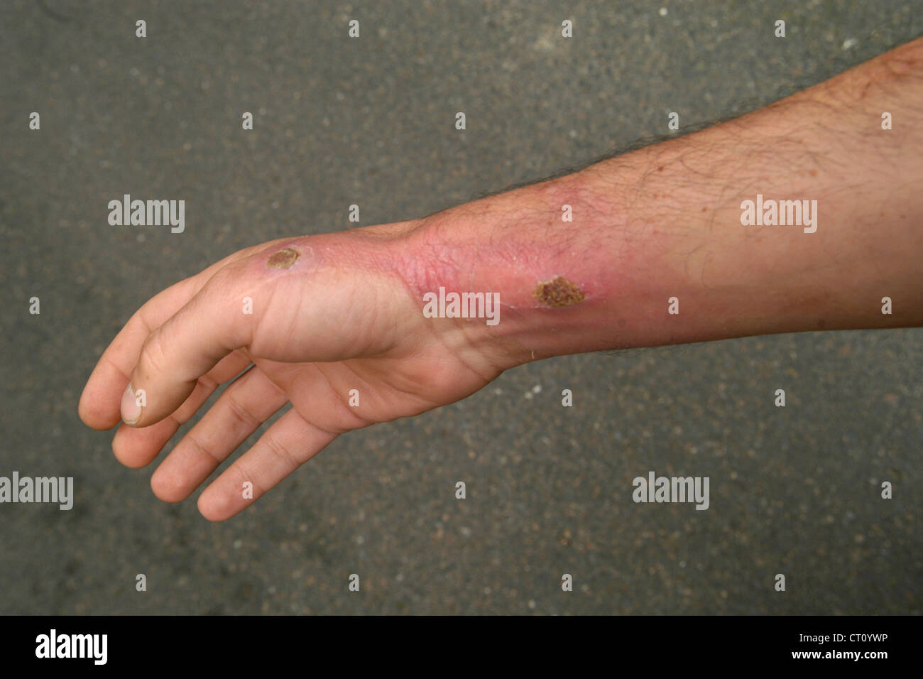 Burn blister arm hi-res stock photography and images - Alamy