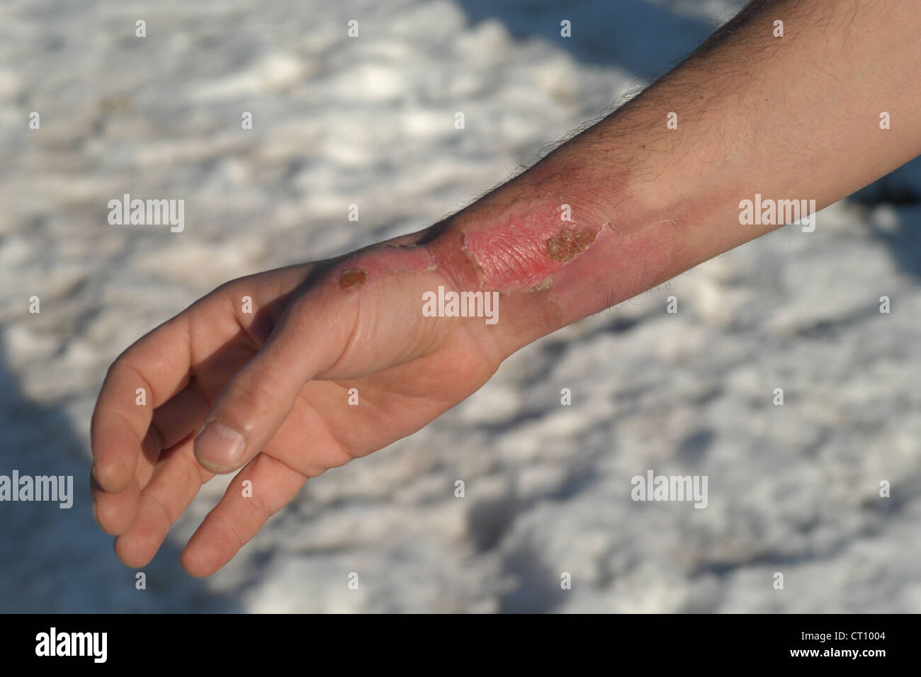Burn blister arm hi-res stock photography and images - Alamy