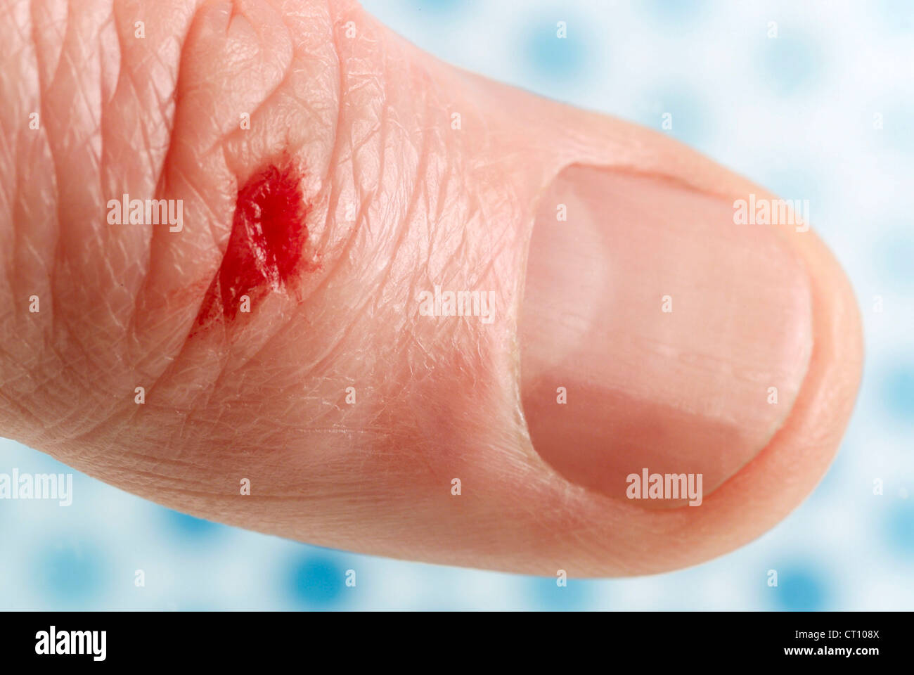 Open Wounds High Resolution Stock Photography and Images - Alamy