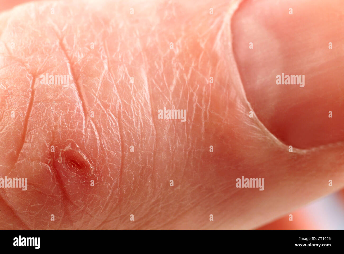 Cicatrization hi-res stock photography and images - Alamy