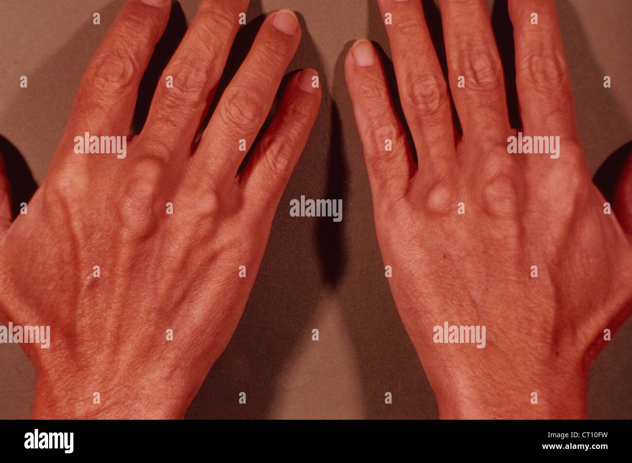 Gout hand hi-res stock photography and images - Alamy