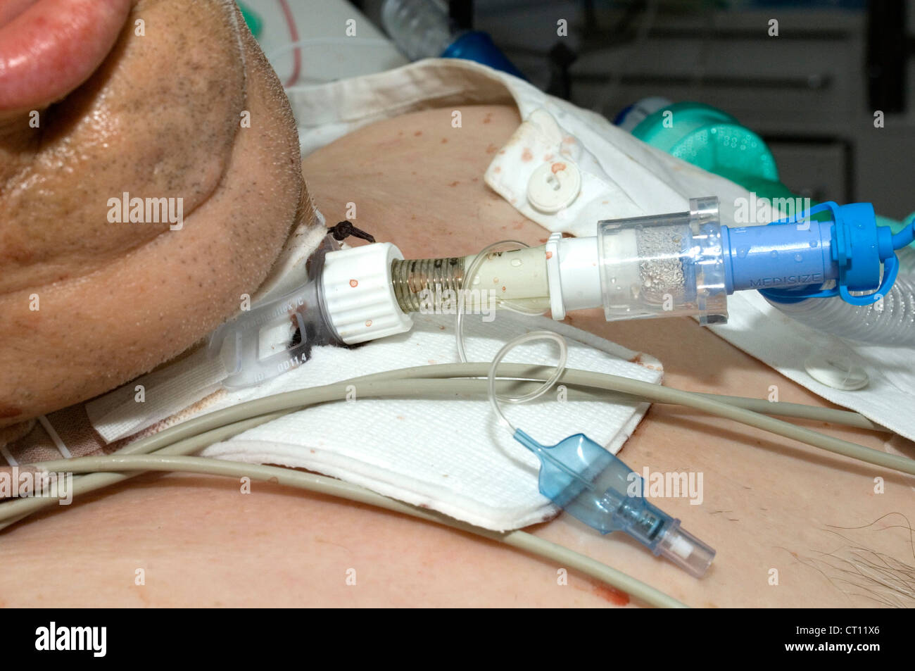 Tracheotomy hi-res stock photography and images - Alamy