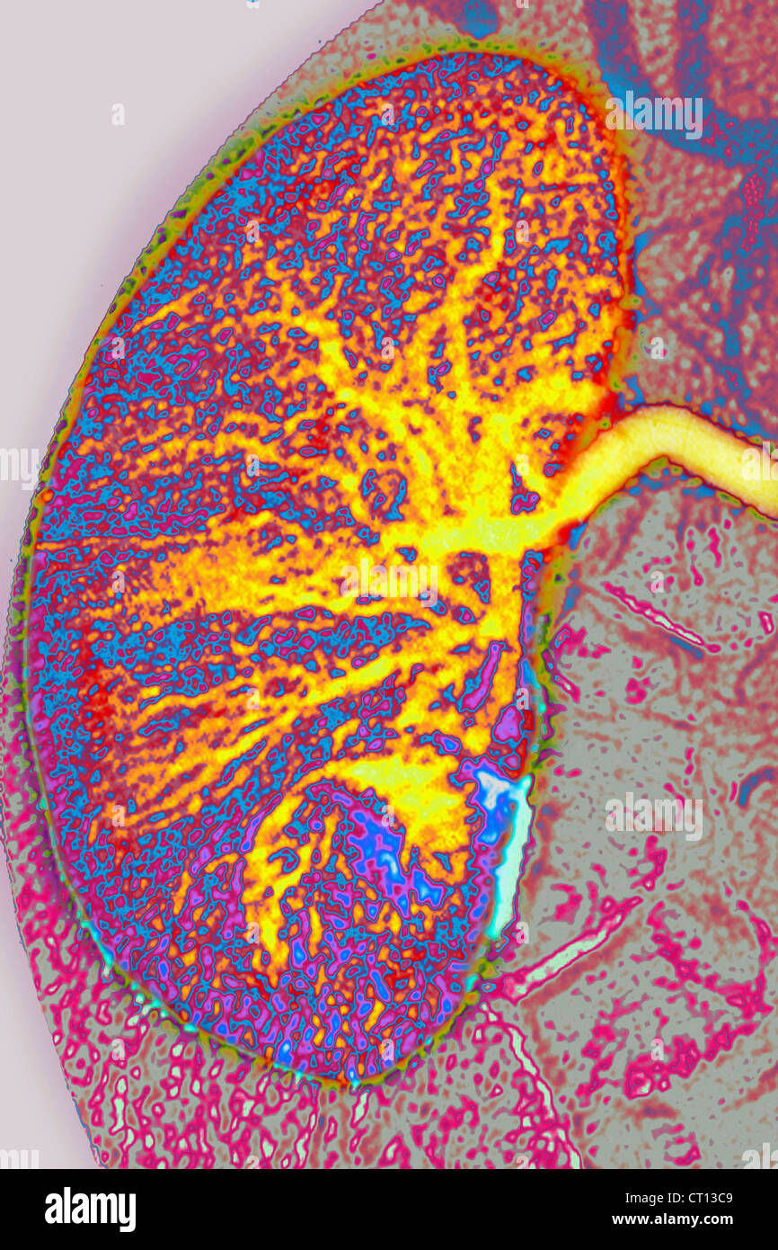 Angiogram normal kidney hi-res stock photography and images - Alamy