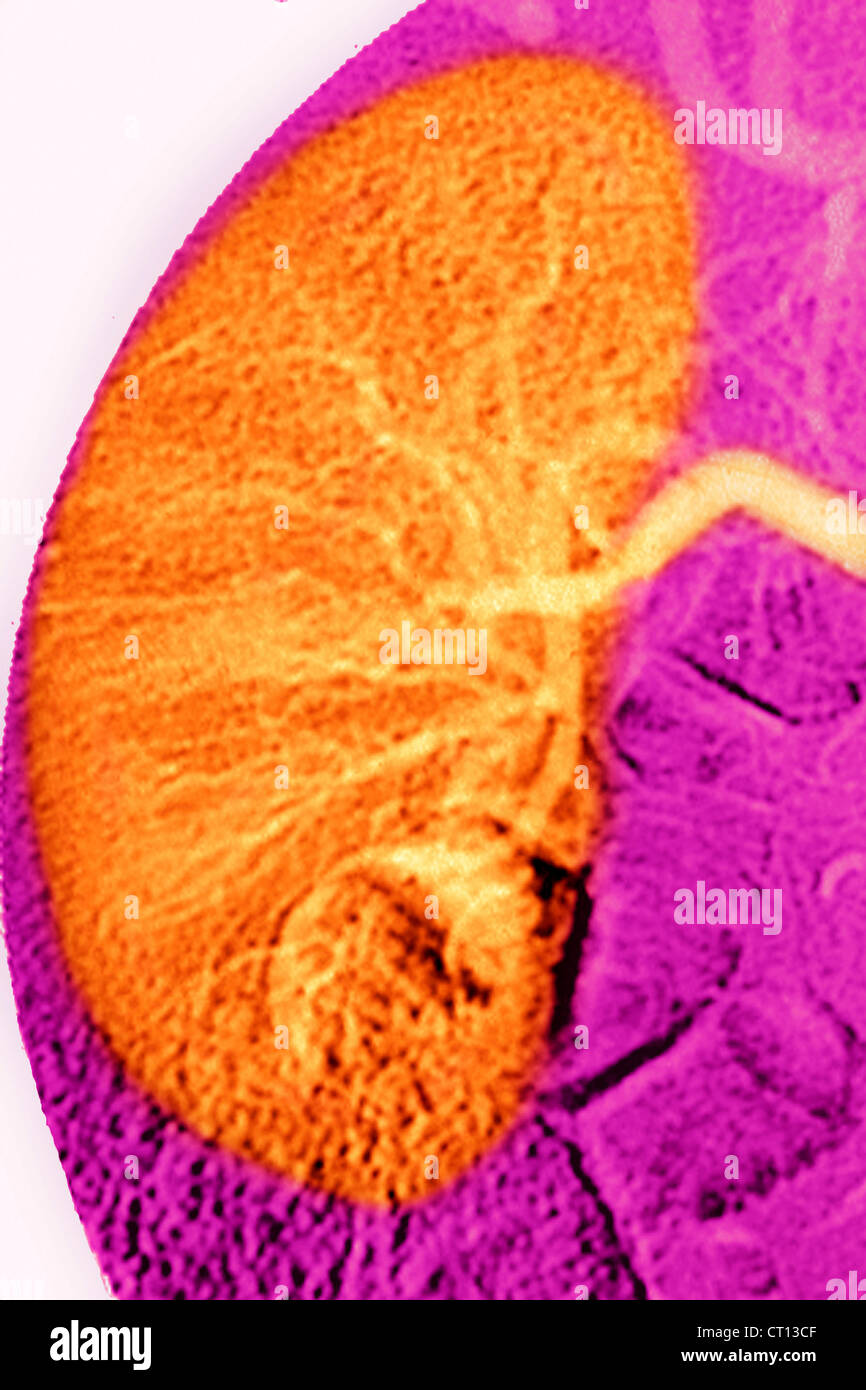 Angiogram normal kidney hi-res stock photography and images - Alamy