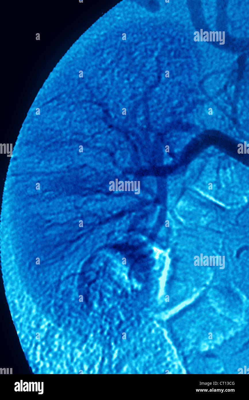 Angiogram kidney hi-res stock photography and images - Alamy