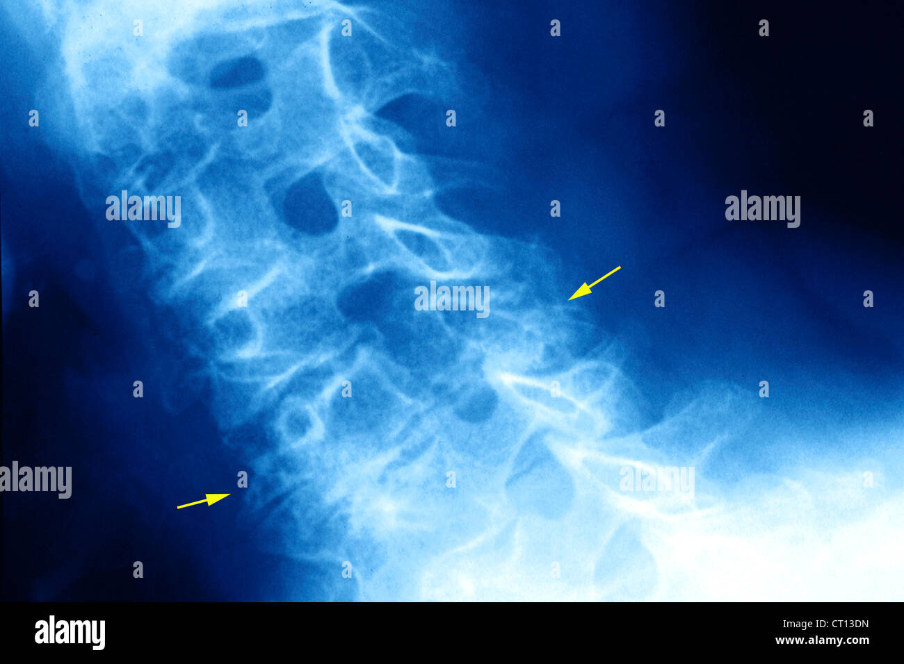 Osteolysis hi-res stock photography and images - Alamy