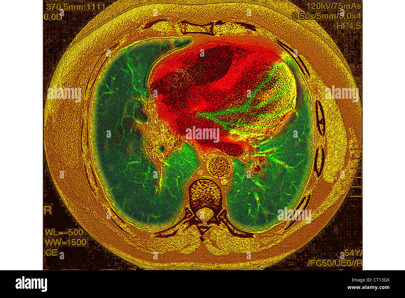 MYOCARDIAL INFARCTION, SCAN Stock Photo - Alamy