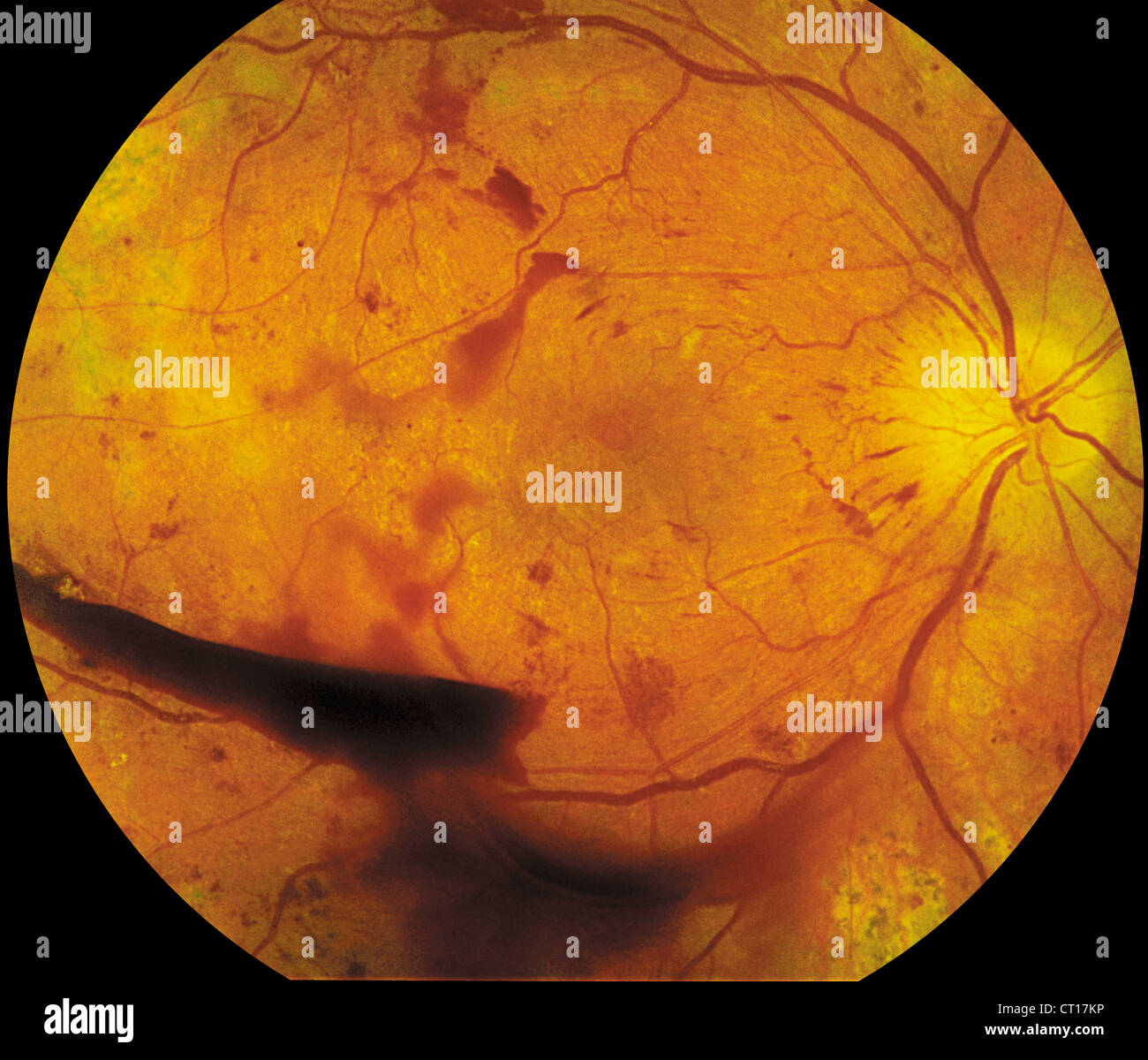 Retinal hemorrhage hi-res stock photography and images - Alamy