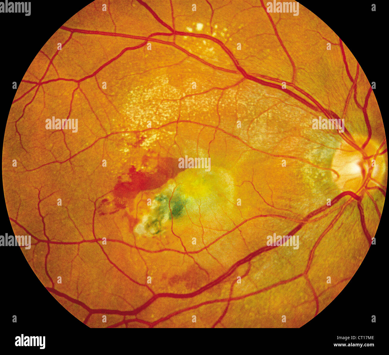 SENILE MACULAR DEGENERATION Stock Photo - Alamy