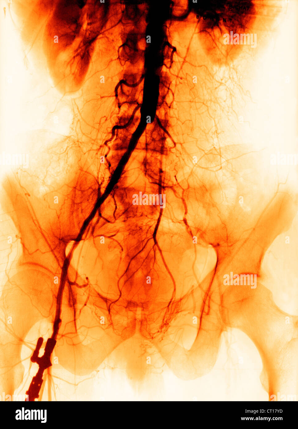 Arterial thrombosis hi-res stock photography and images - Alamy