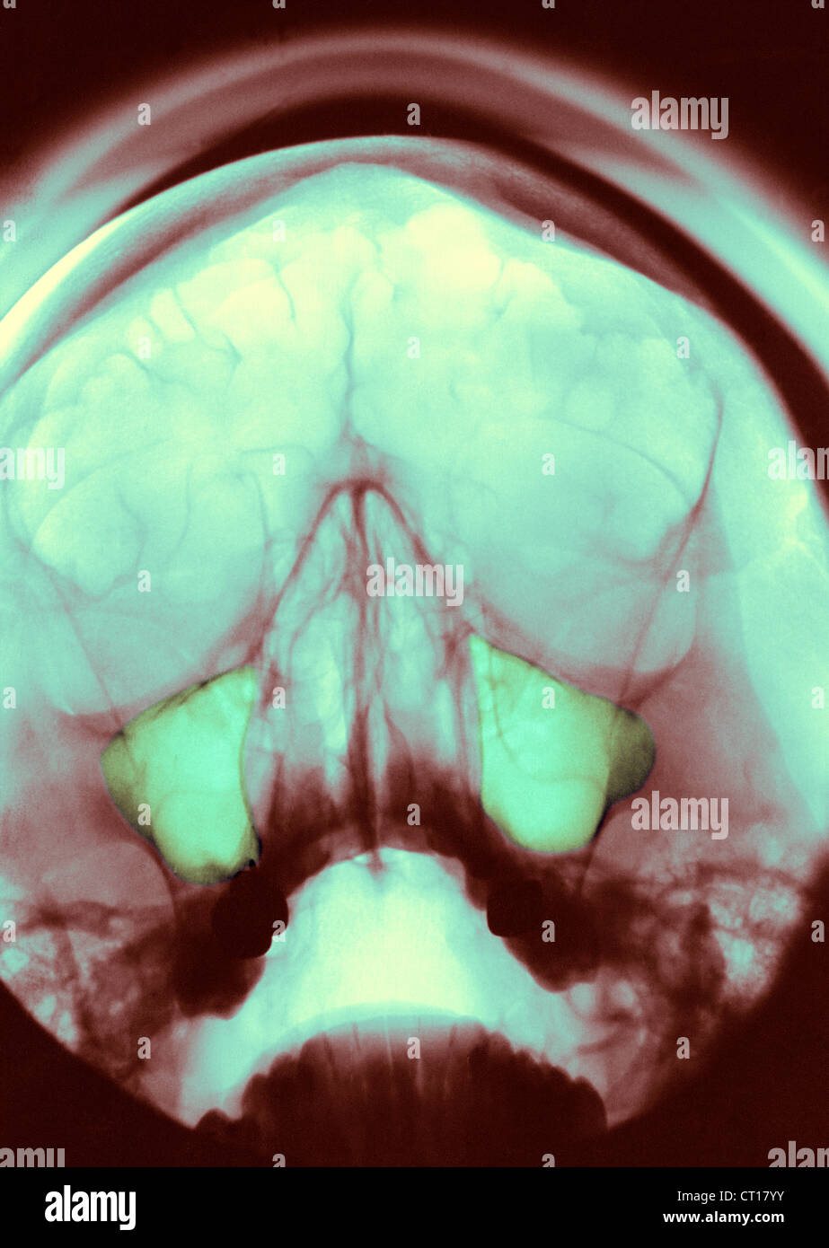 Normal x ray of sinuses hi-res stock photography and images - Alamy