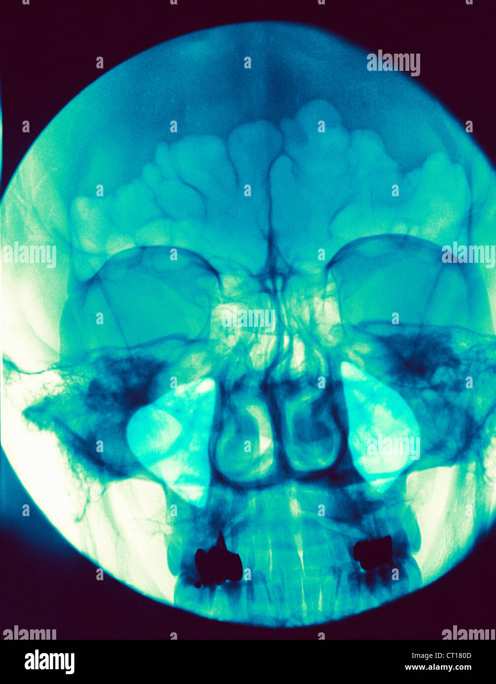 Normal x ray of sinuses hi-res stock photography and images - Alamy