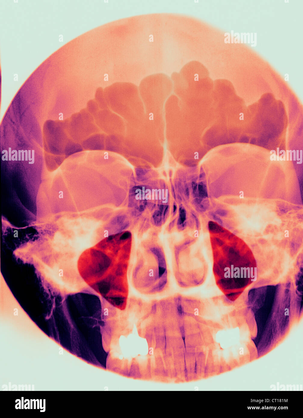 Normal x ray of sinuses hi-res stock photography and images - Alamy