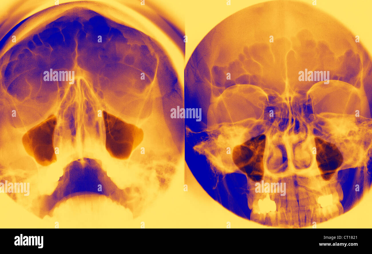 Normal x ray of sinuses hi-res stock photography and images - Alamy