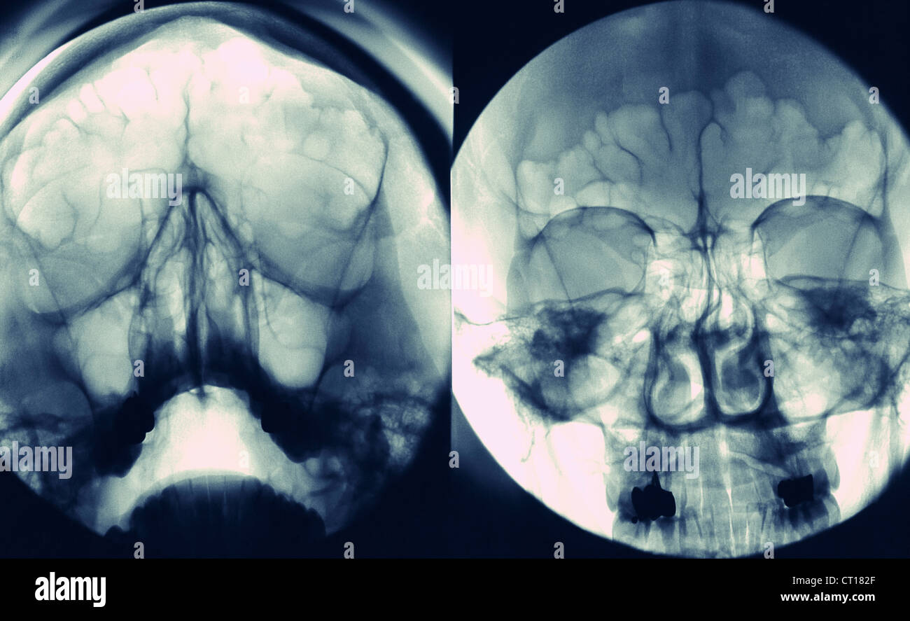 Normal x ray of sinuses hi-res stock photography and images - Alamy
