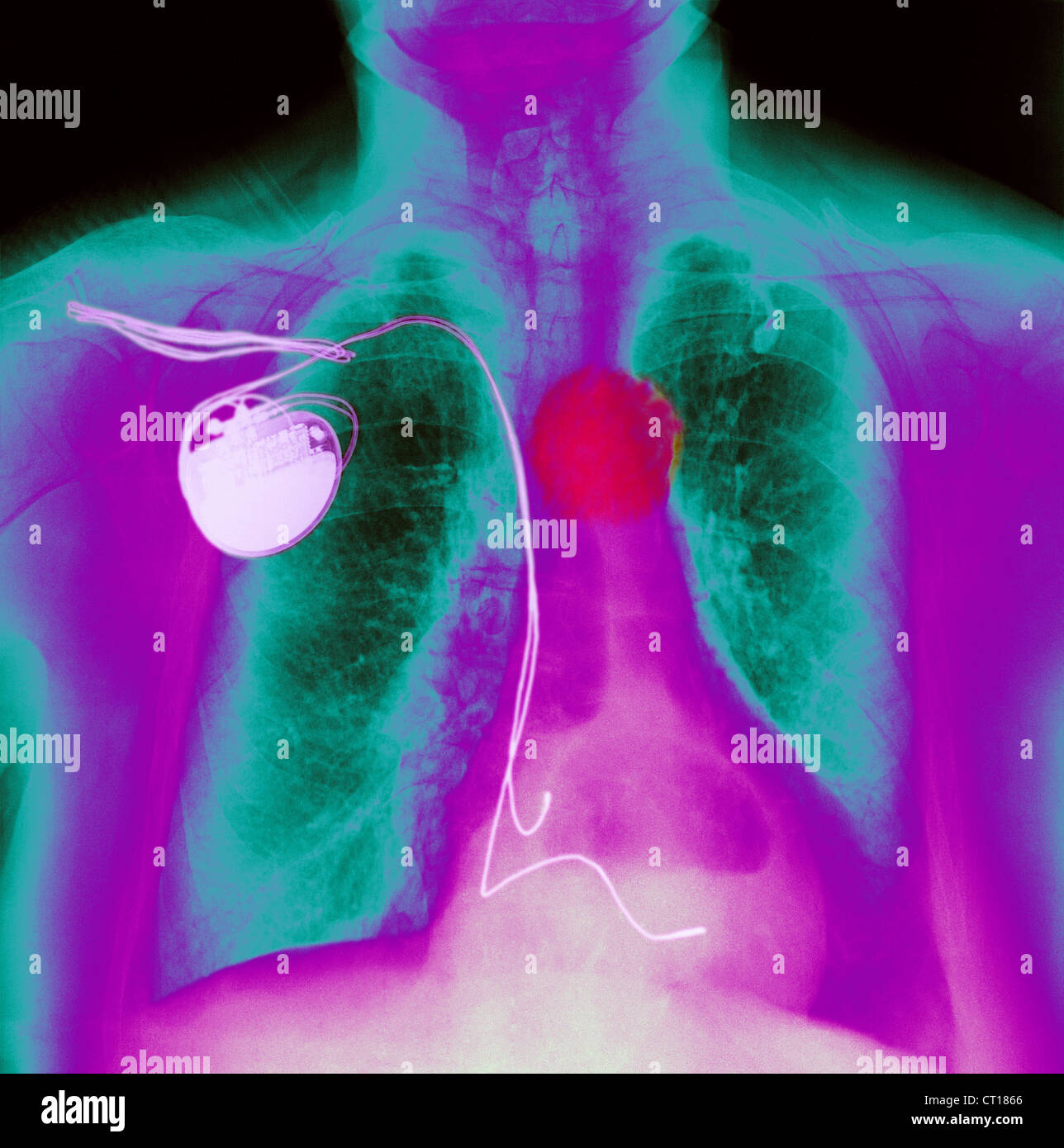 Cardio oesophagus hi-res stock photography and images - Alamy