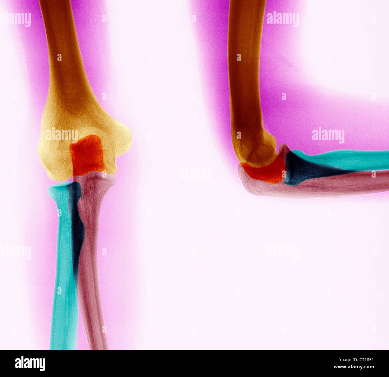 Normal elbow joint, x ray hi-res stock photography and images - Alamy