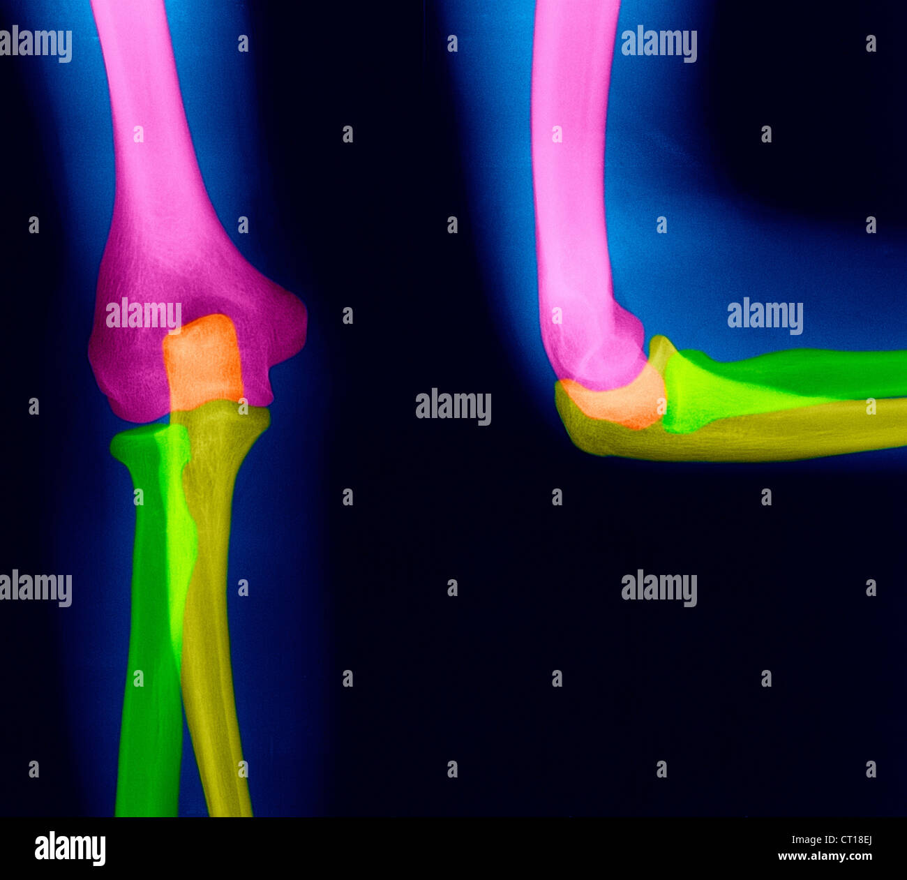 Normal elbow joint, x ray hi-res stock photography and images - Alamy