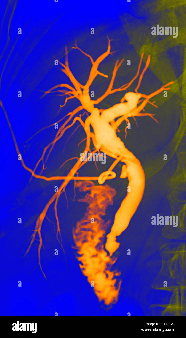 Ductus biliaris hi-res stock photography and images - Alamy