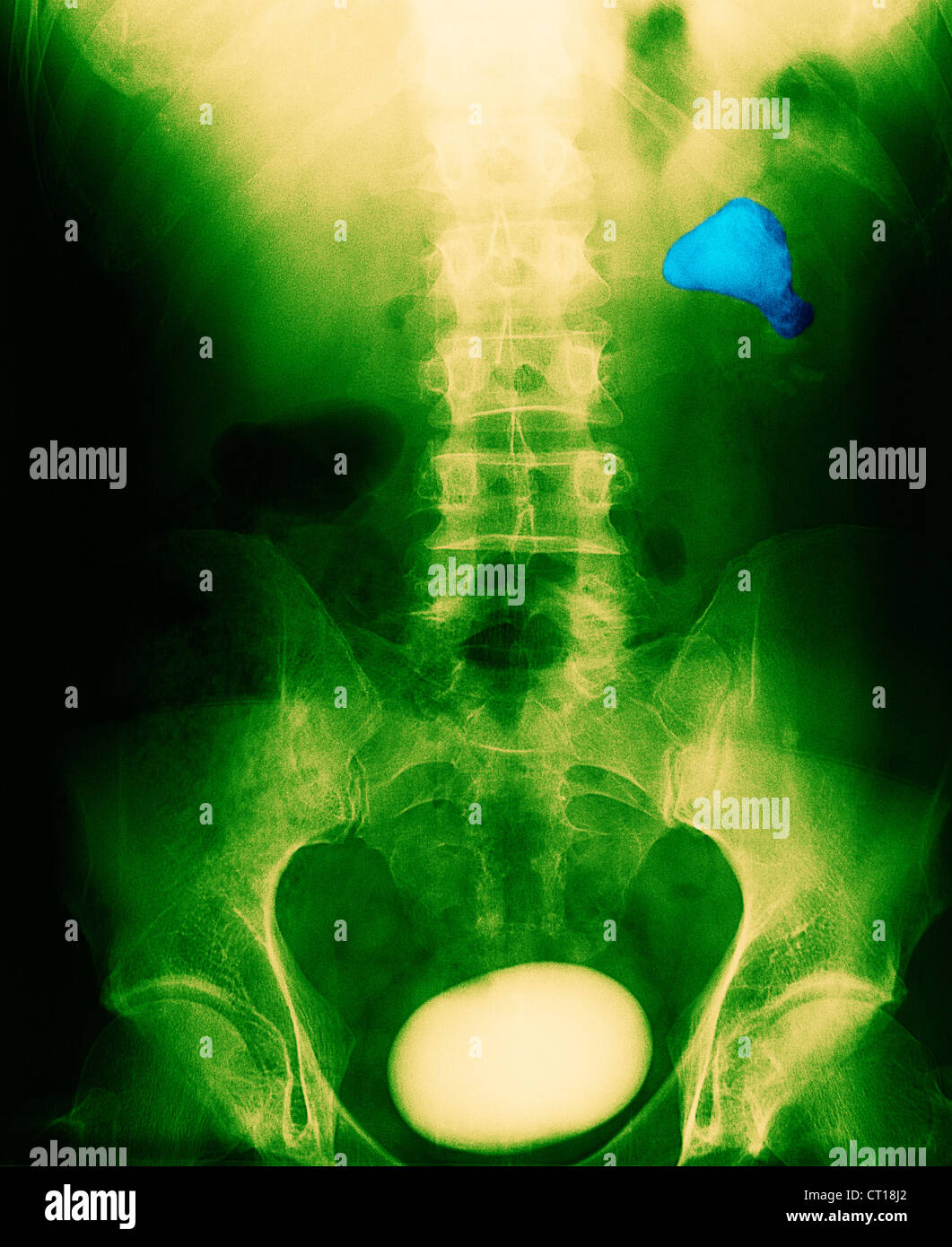 RENAL LITHIASIS, X-RAY Stock Photo - Alamy