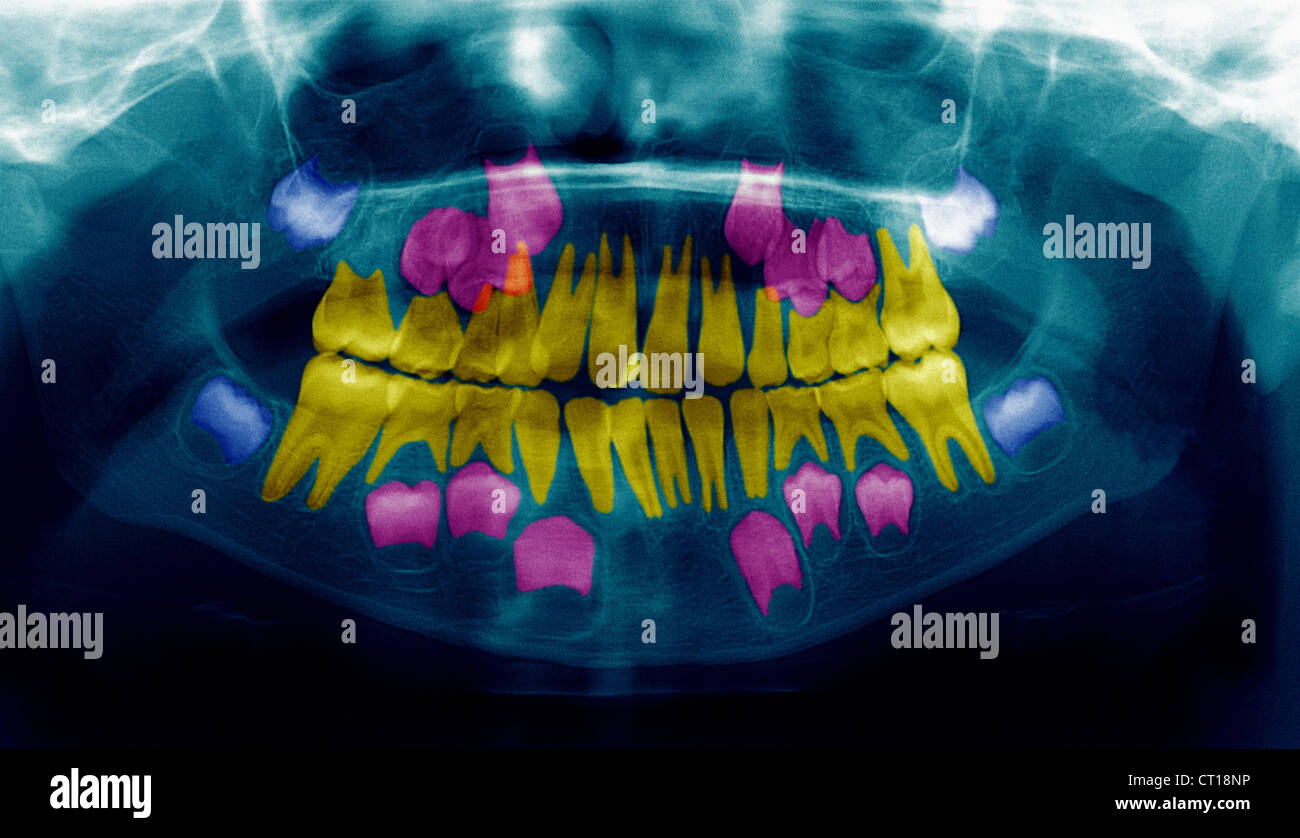 CHILD TOOTH, X-RAY Stock Photo - Alamy