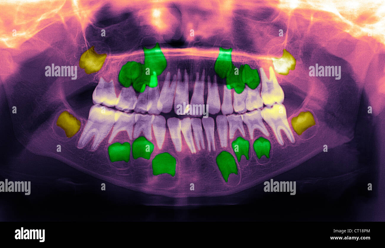 CHILD TOOTH, X-RAY Stock Photo - Alamy
