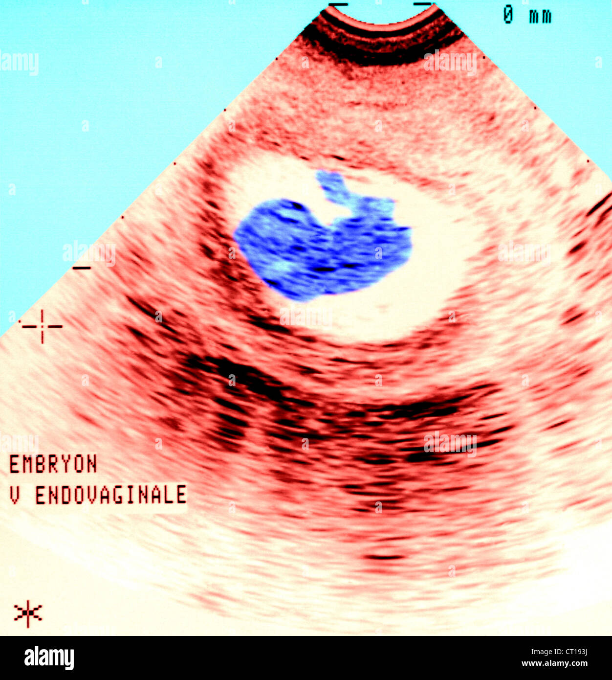 3 month fetus hi-res stock photography and images - Alamy