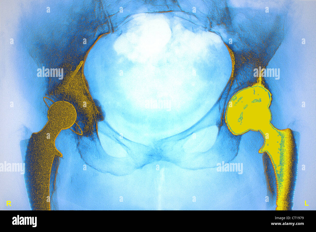 Hip replacements hi-res stock photography and images - Alamy
