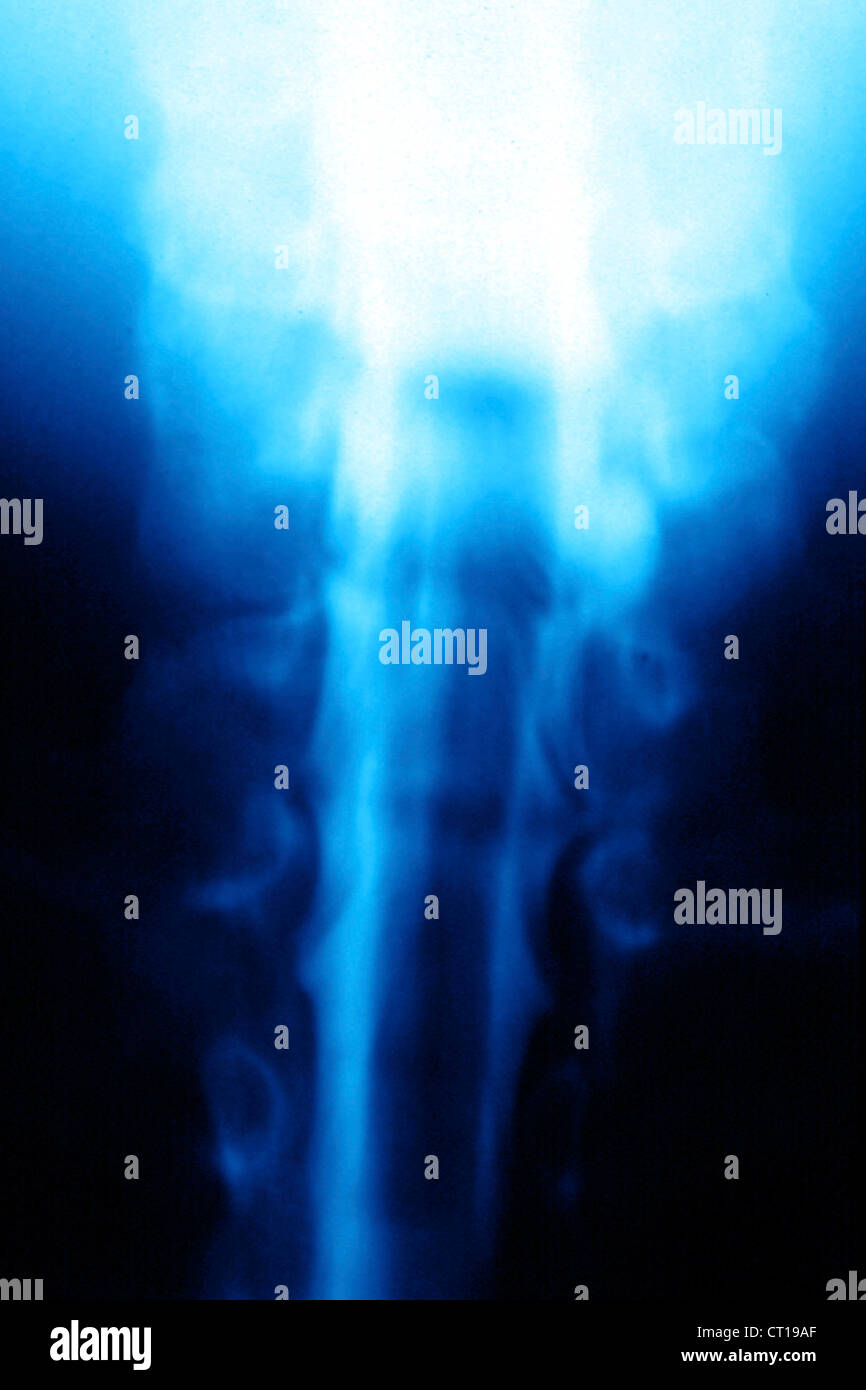 MENINGOCELE X-RAY RESULT Stock Photo - Alamy