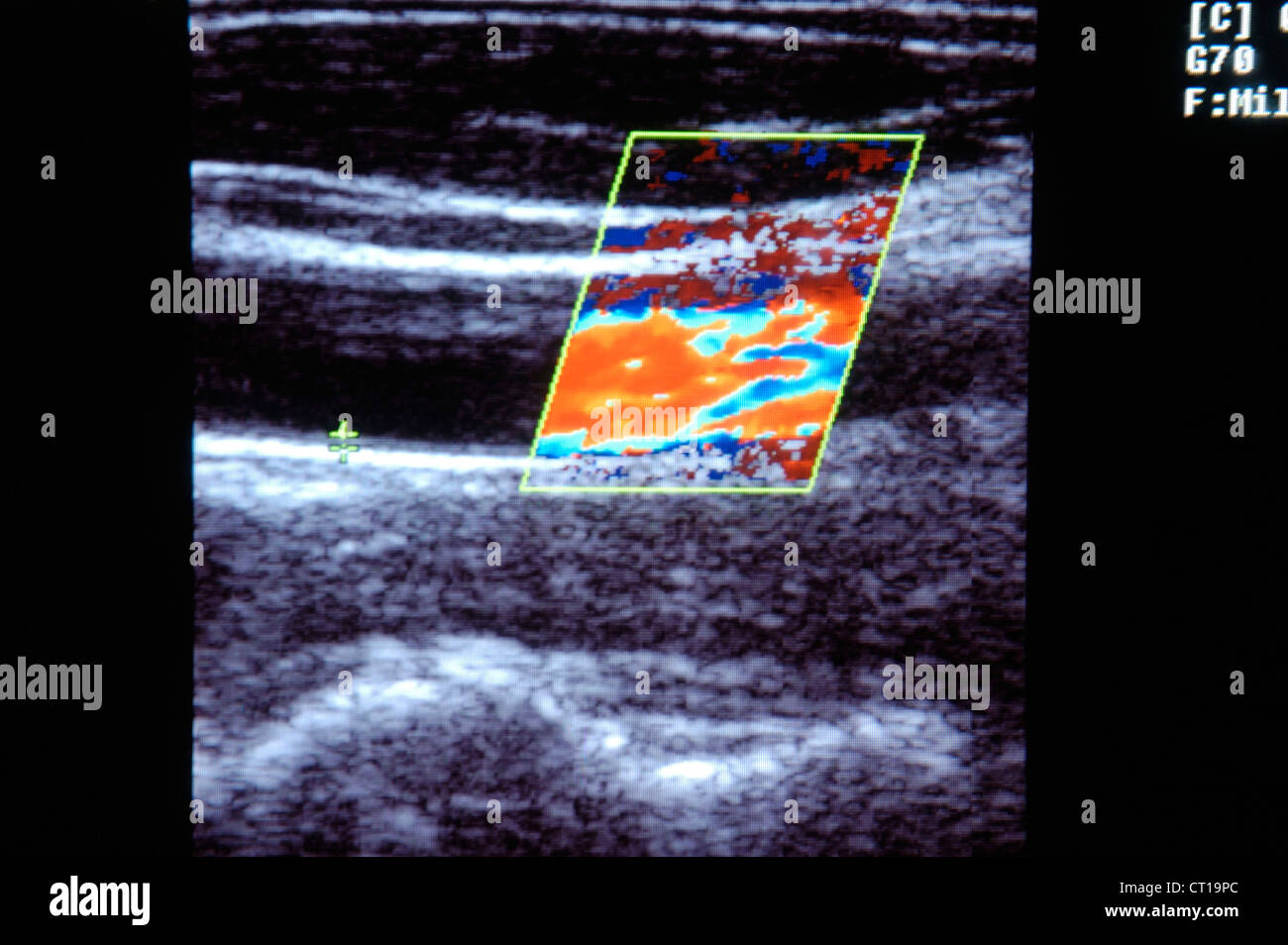 DOPPLER TEST OF A CAROTID Stock Photo - Alamy