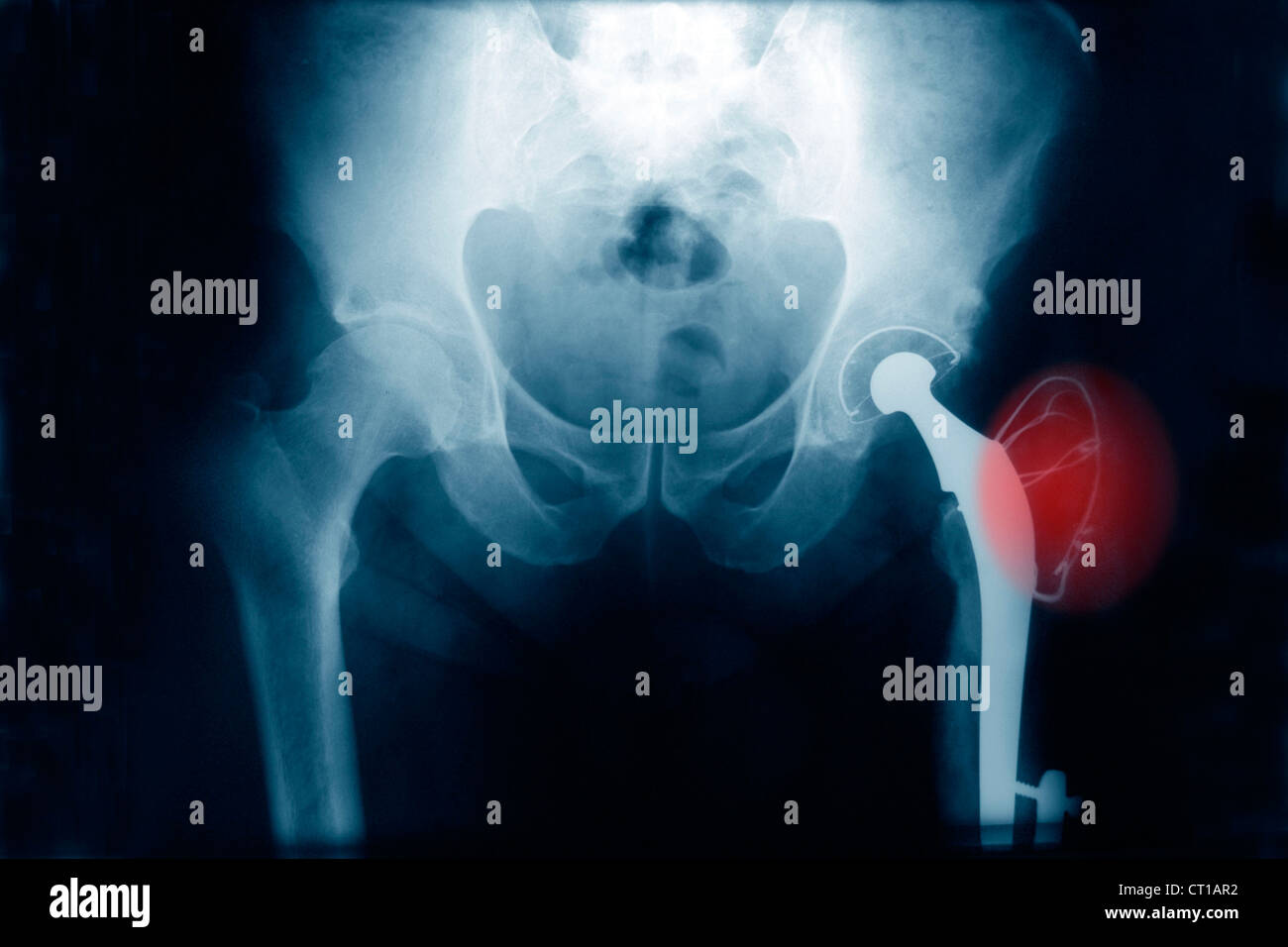 HIP PROSTHESIS, X-RAY Stock Photo - Alamy