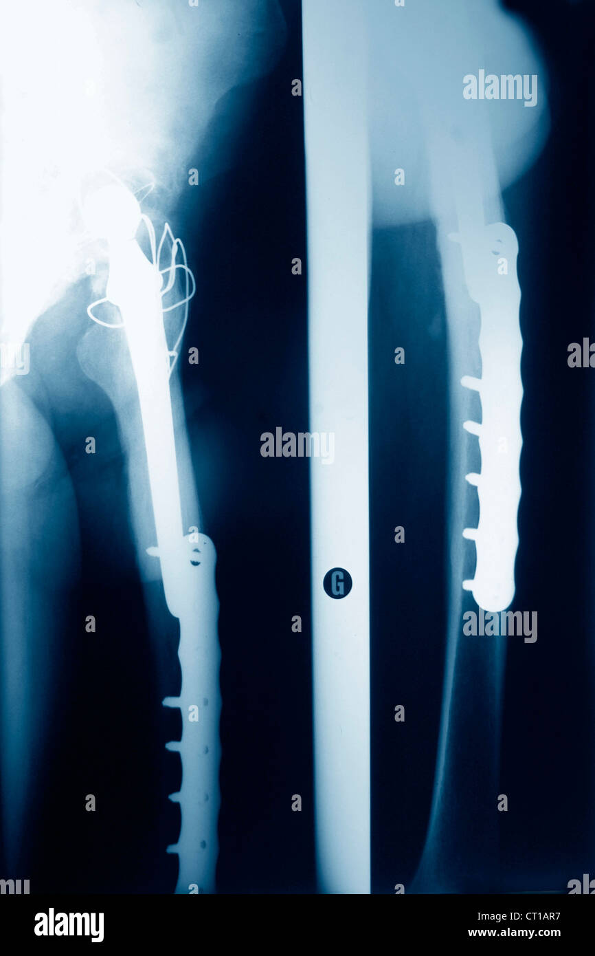 HIP PROSTHESIS, X-RAY Stock Photo - Alamy HIP PROSTHESIS, X-RAY Stock Photo - Alamy