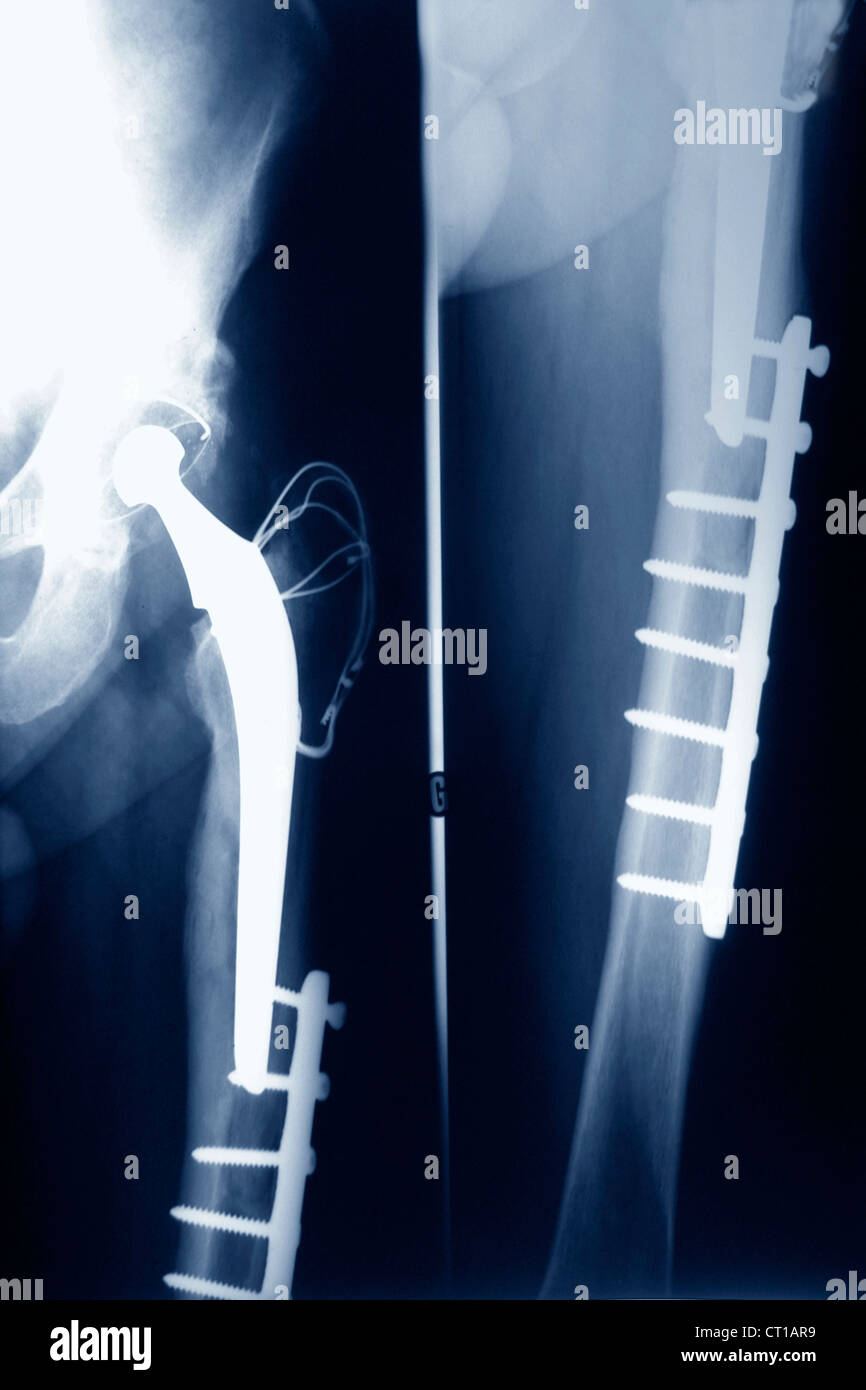 HIP PROSTHESIS, X-RAY Stock Photo - Alamy