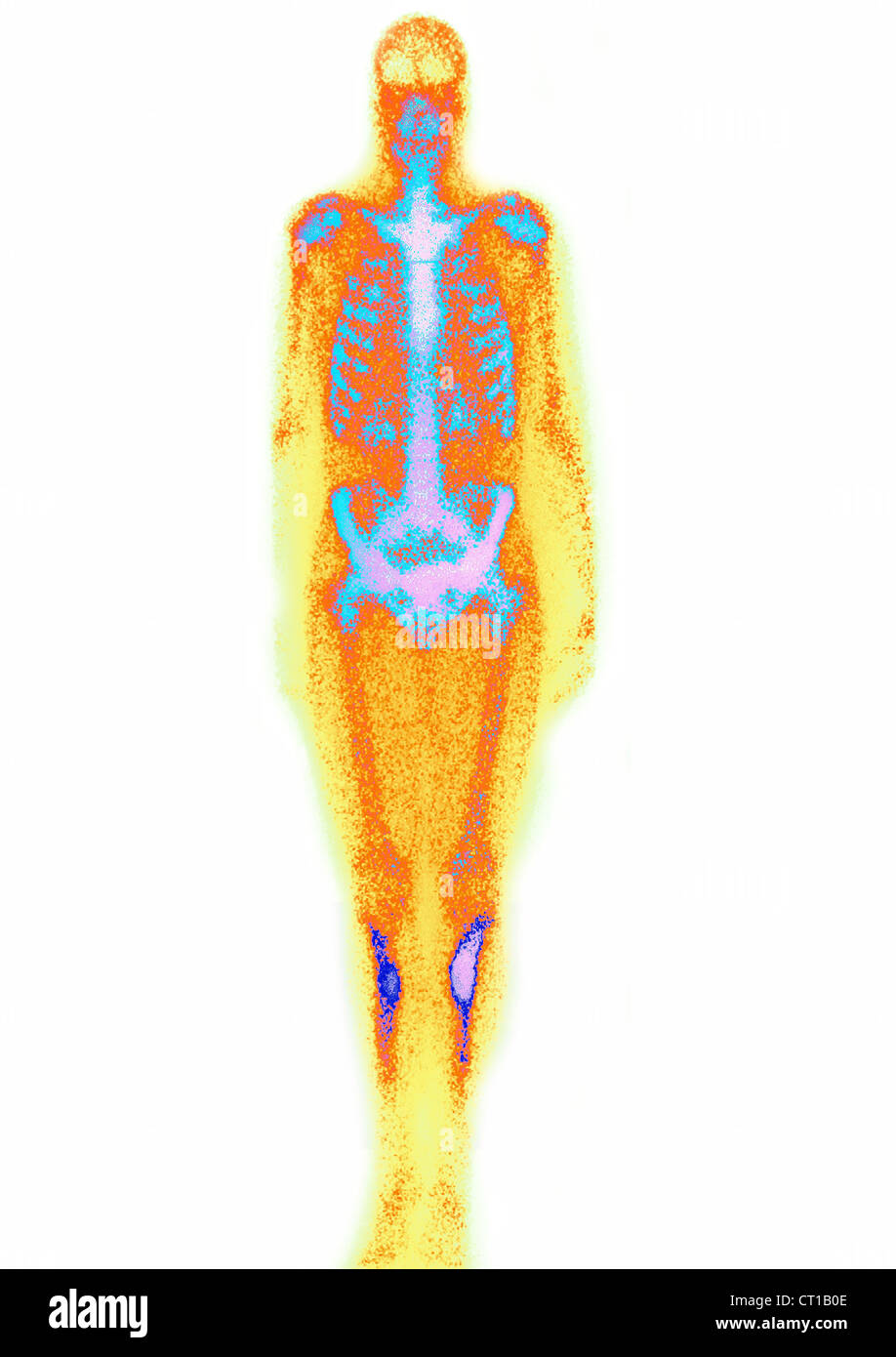 Fatigue fracture hi-res stock photography and images - Alamy