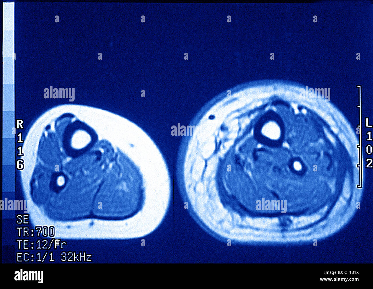 EDEMA OF THE LEG Stock Photo - Alamy