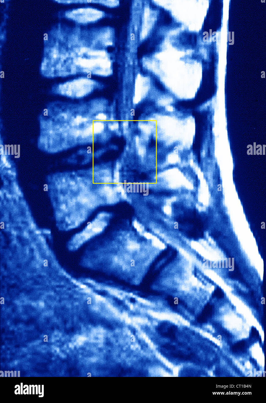 HERNIATED DISK, MRI Stock Photo - Alamy