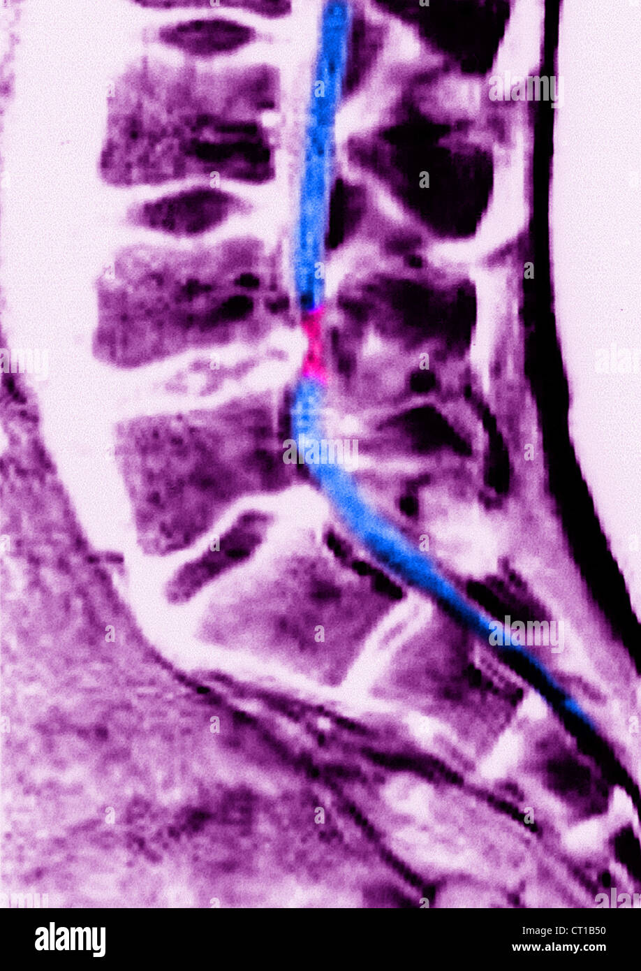 Herniated disk mri hi-res stock photography and images - Alamy