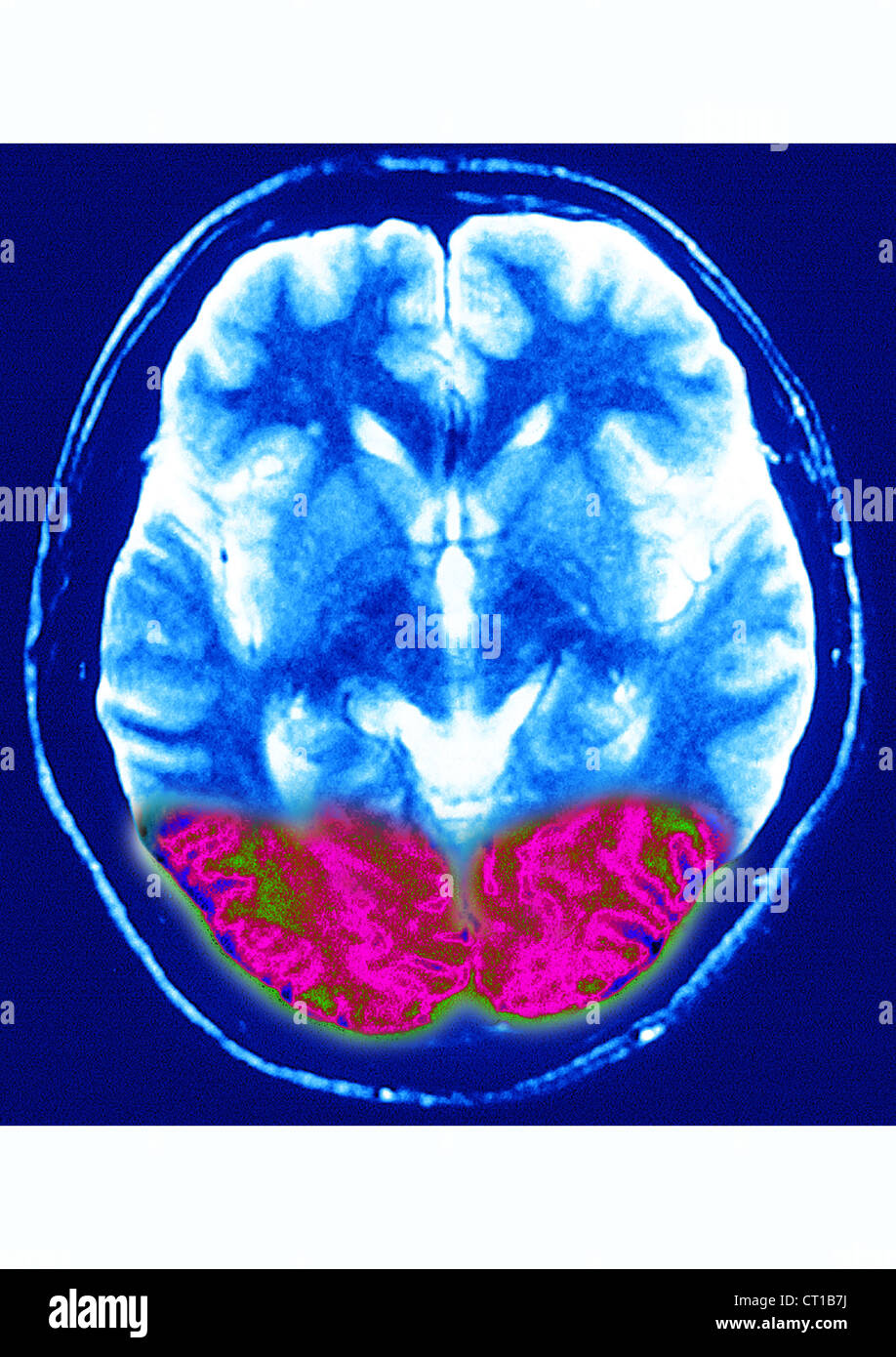 Healthy brain scan hi-res stock photography and images - Alamy