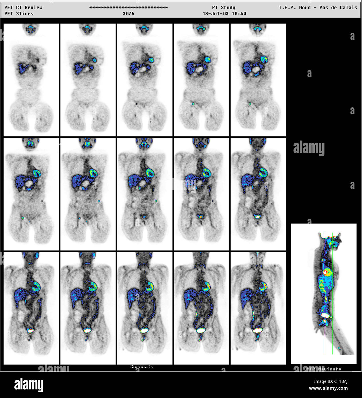 MALT LYMPHOMA, PETSCAN Stock Photo - Alamy