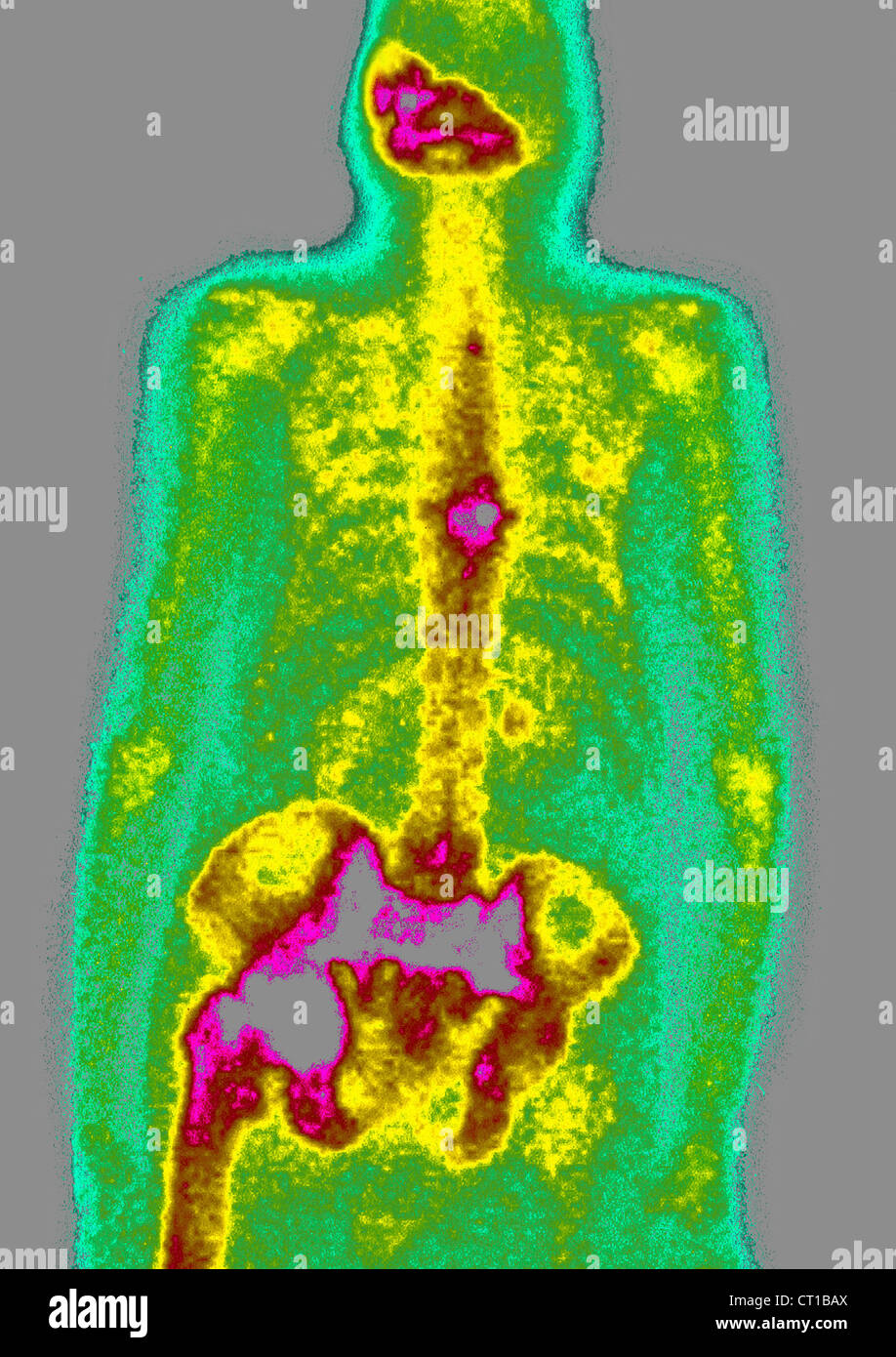 Pagets disease of bone hi-res stock photography and images - Alamy