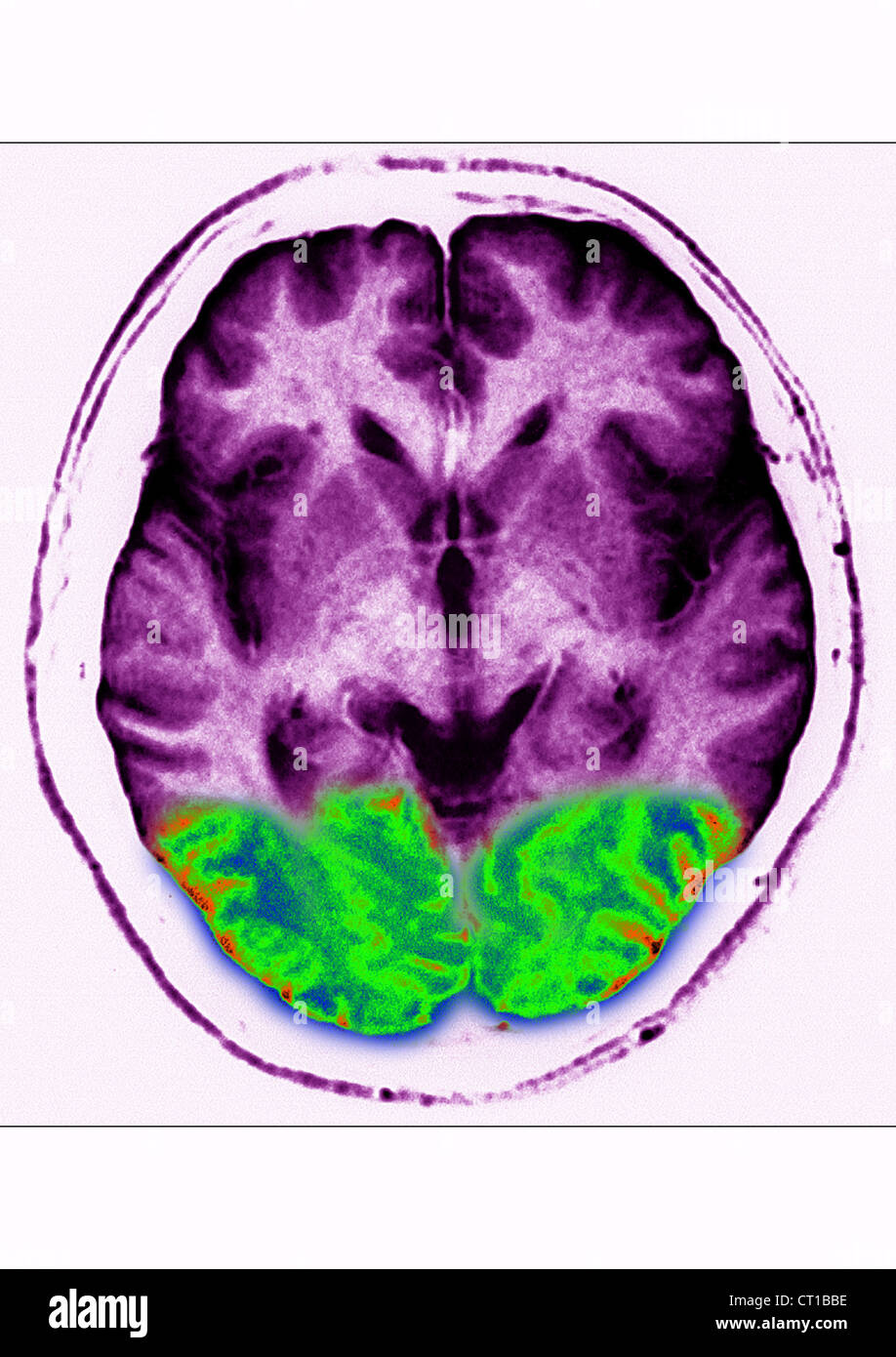 Normal brain scan hi-res stock photography and images - Alamy