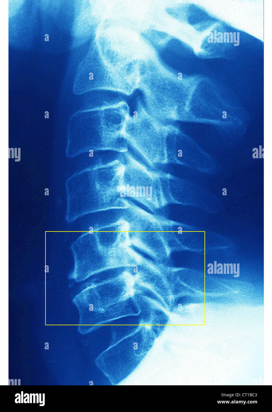 CERVICAL OSTEOARTHRITIS, X-RAY Stock Photo - Alamy