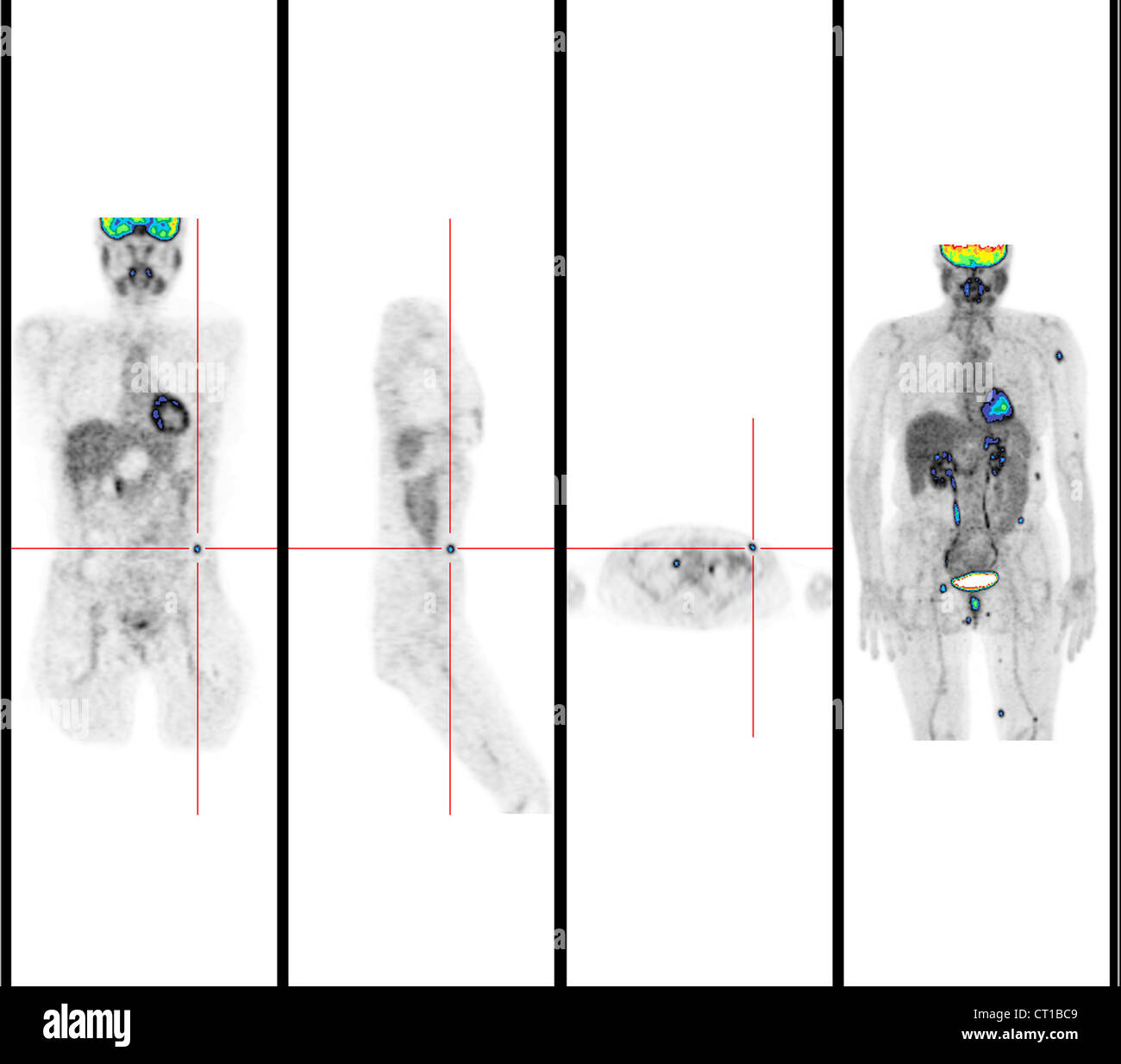 MALT LYMPHOMA, PETSCAN Stock Photo - Alamy