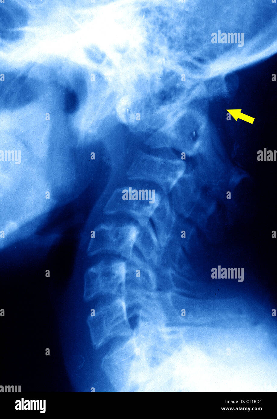 DISLOCATION SHOULDER, X-RAY Stock Photo - Alamy