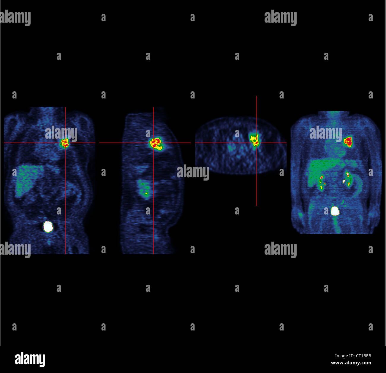 Pet scan lungs hi-res stock photography and images - Alamy
