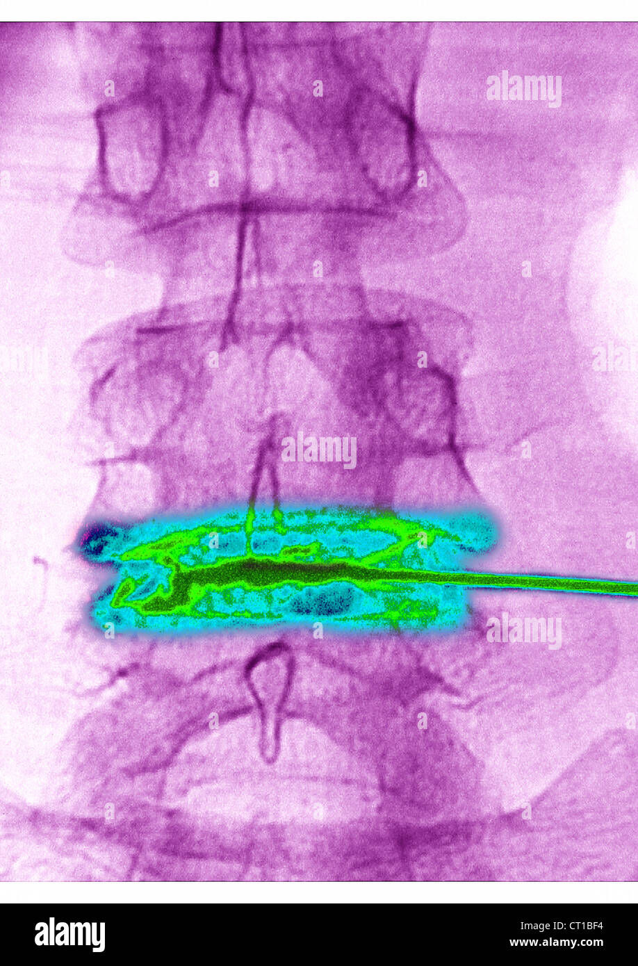 Nucleolysis hi-res stock photography and images - Alamy