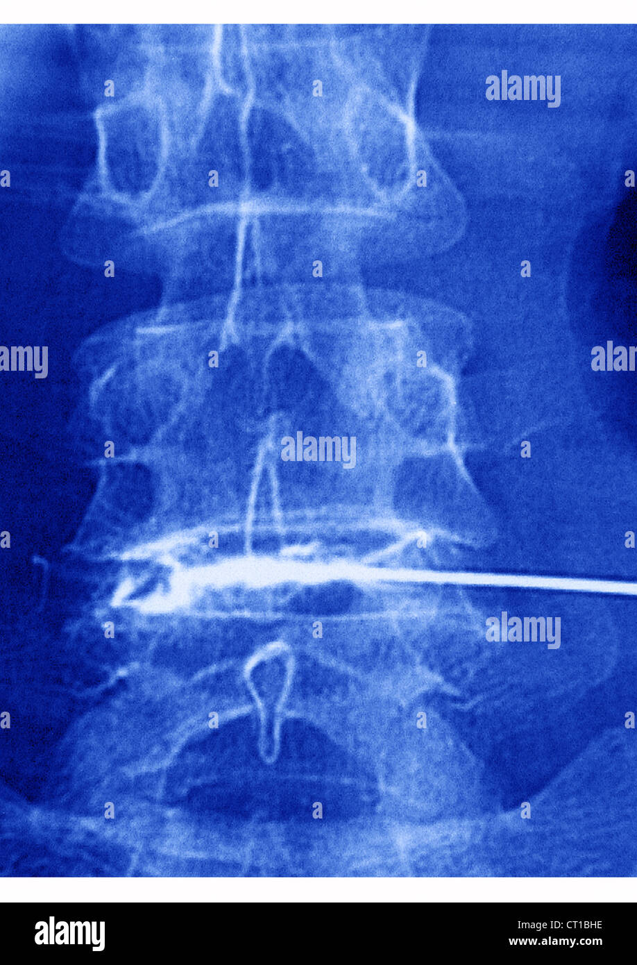 Nucleolysis hi-res stock photography and images - Alamy