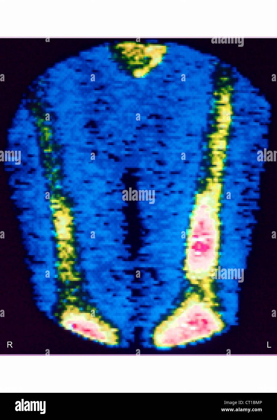 FATIGUE FRACTURE, SCINTISCAN Stock Photo - Alamy
