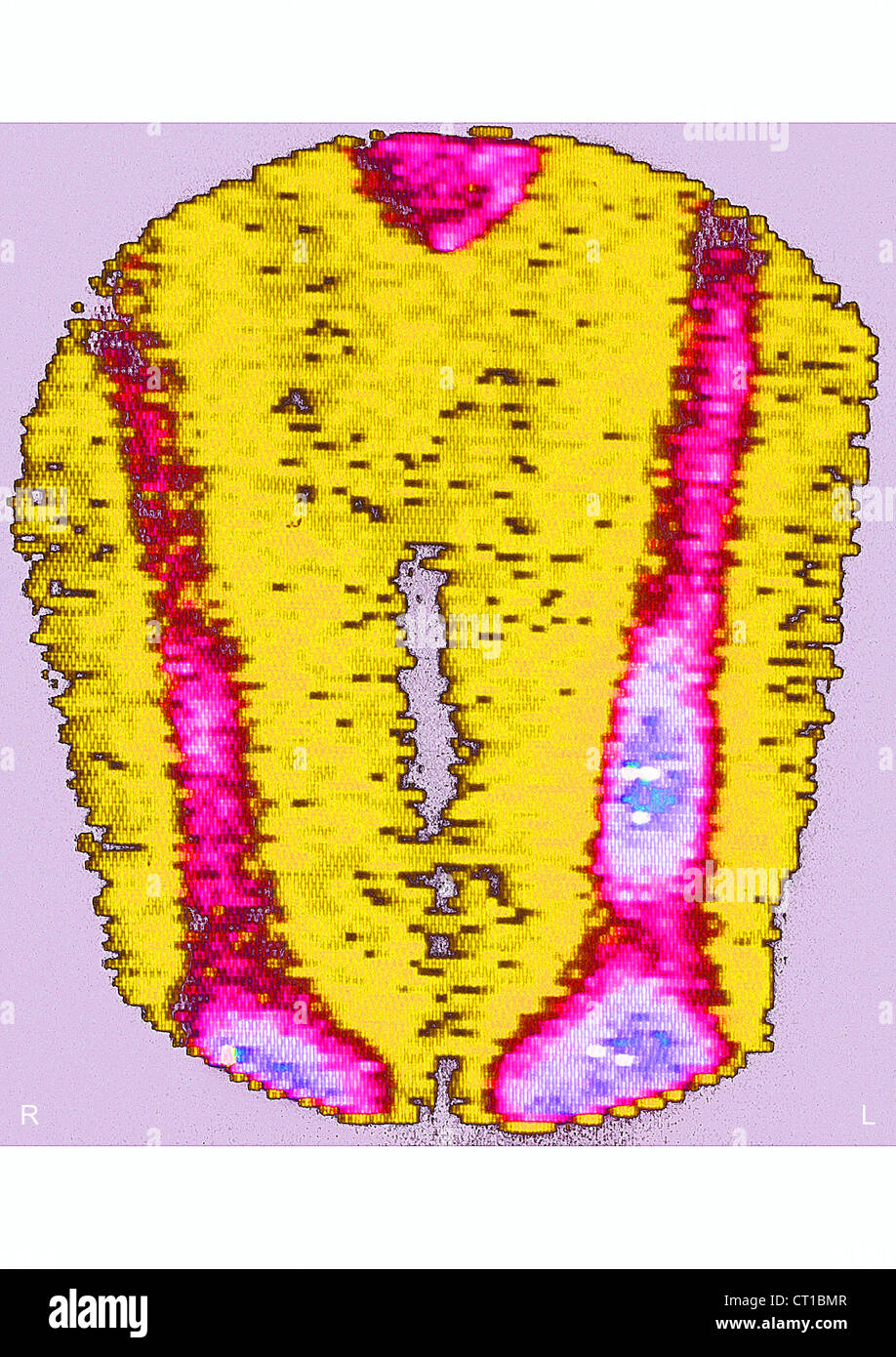 Fatigue fracture hi-res stock photography and images - Alamy