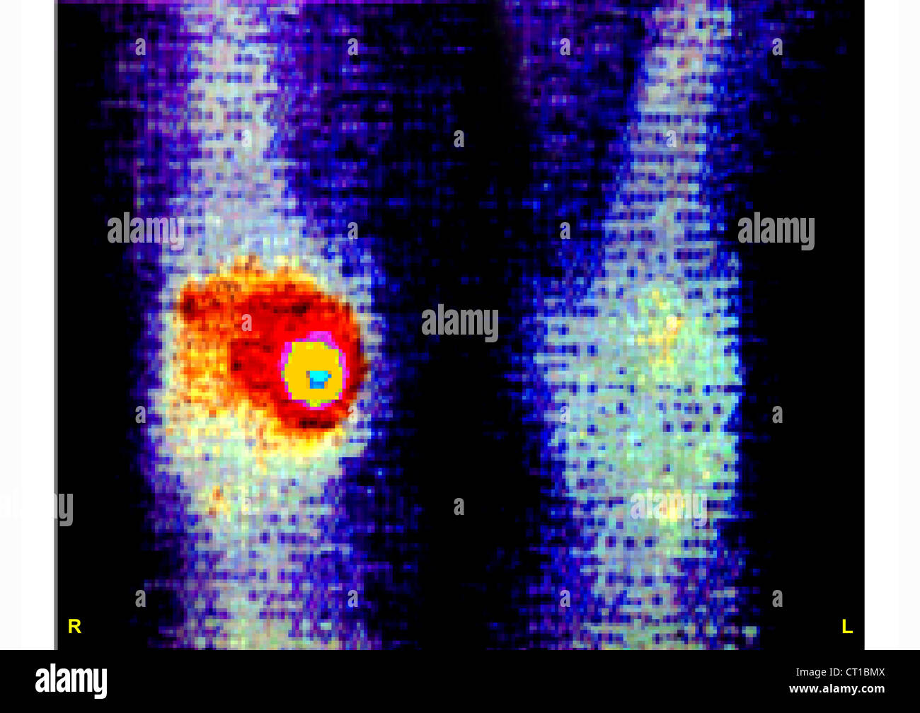 Scintiscanner result hi-res stock photography and images - Alamy